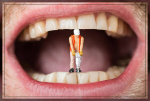 What is Calculus Bridge? Its Types, Causes, Effects, Prevention, and ...