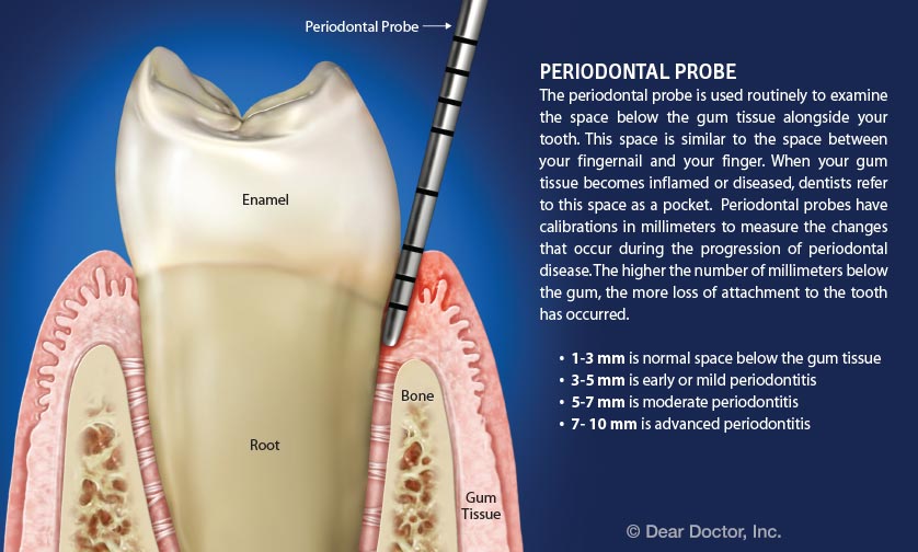 Understanding Periodontal Disease and How a Dentist Can Help ...