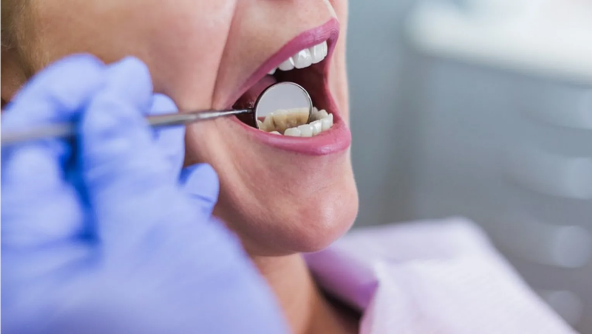 A Natural Approach to Fighting Cavities and Strengthening Teeth ...